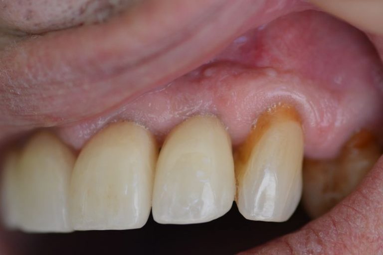 Dental Implants - Kamloops Periodontist